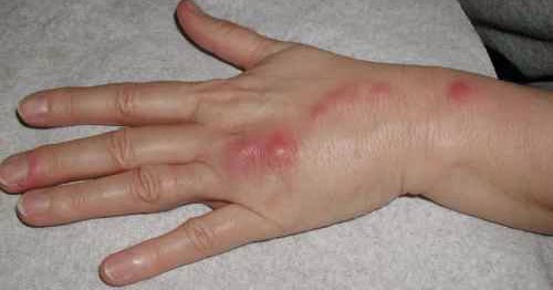 microbiology: Sporotrichosis