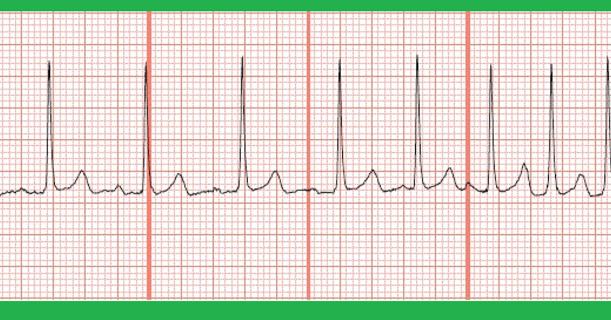 Float Nurse: Various Multifocal Atrial Tachycardias