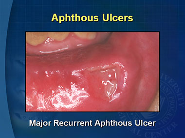 Discovering Aphthous Stomatitis