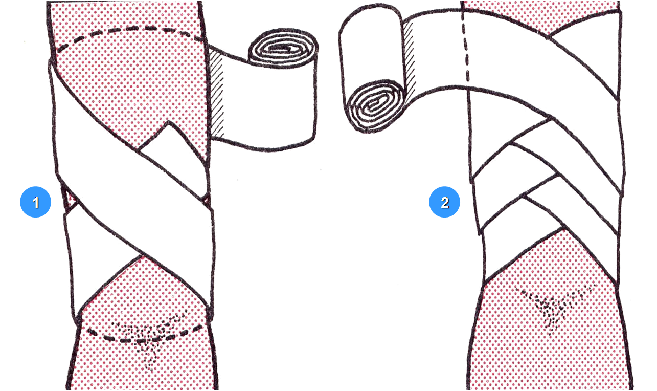 crescentsmexcel: Jenis-Jenis Balutan Luka