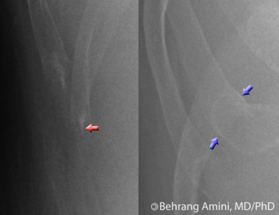 Roentgen Ray Reader: Costal Cartilage Mineralization and Gender