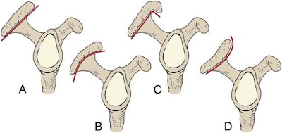 PT Rextify : Acromial Types 各種形狀的 Acromion