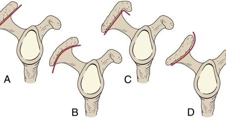 PT Rextify : Acromial Types 各種形狀的 Acromion