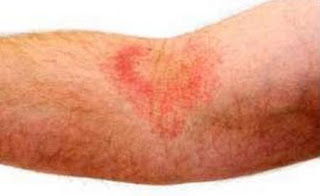 Cara Alami Menyembuhkan Penyakit Eksim | BERBAGI INFO : Tips Trik ...