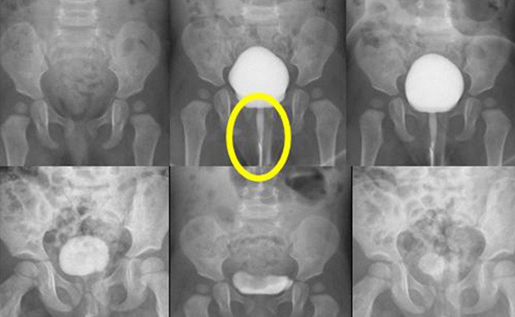 EXAMES CONTRASTADOS - URETROCISTOGRAFIA MICCIONAL DE CRIANÇA