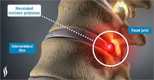 .: Cara Mengurangkan Sakit Slipped Disc
