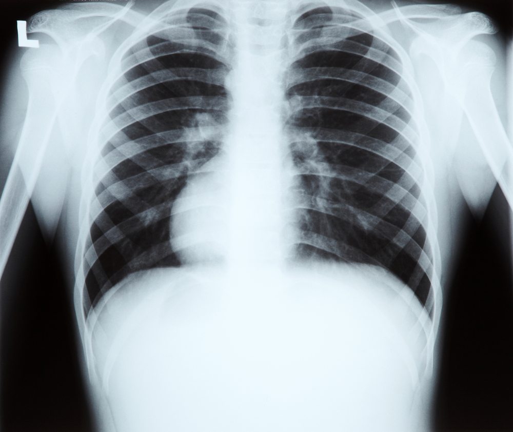 Promieniowanie rentgenowskie: maja 2012