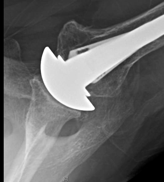 Shoulder Arthritis / Joint Replacement : Ream and Run - function at 11 ...