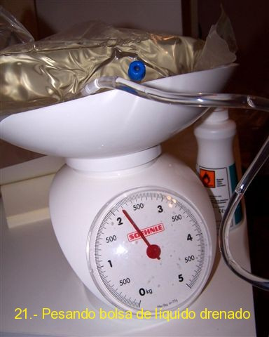 DIALISIS: DIALISIS PERITONEAL