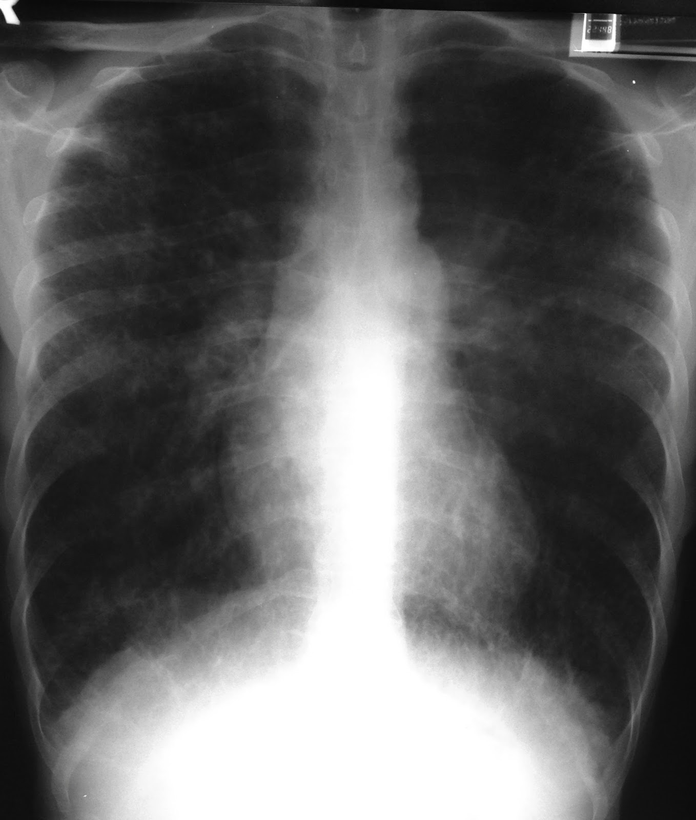 CVT Medical Students: Emphysematous lungs/ Pneumothorax/ Subcutaneous ...