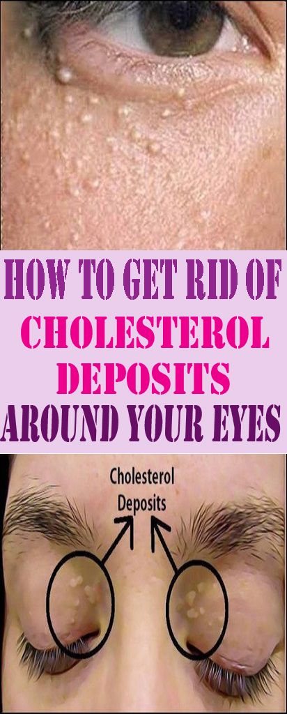 Home Remedies for Cholesterol Deposits Around the Eyes | Health