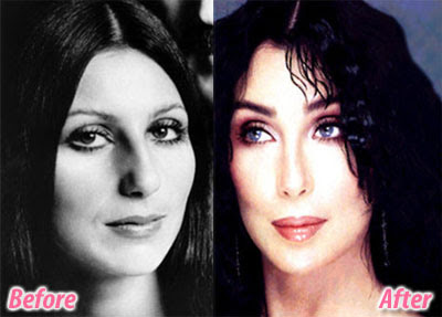 Cher plastic surgery Before and After Botox and Nose Jobs (Star plastic ...