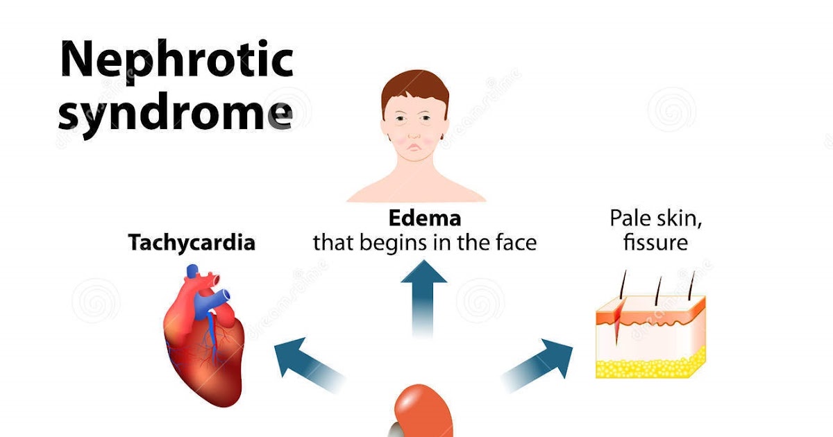 Prepare for Medical Exams : Causes Of Nephrotic Syndrome