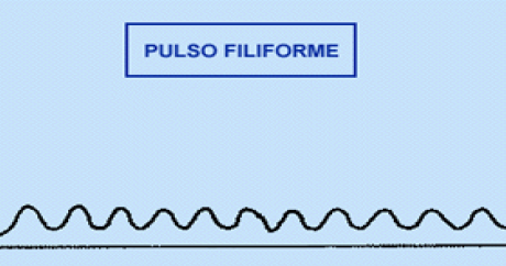 pulso-filiforme-cardiologia.png