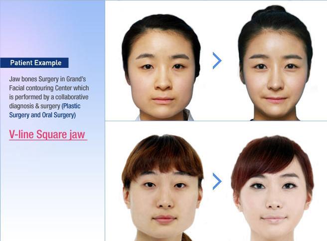 Grand Plastic Surgery: How to get a small v-line face?