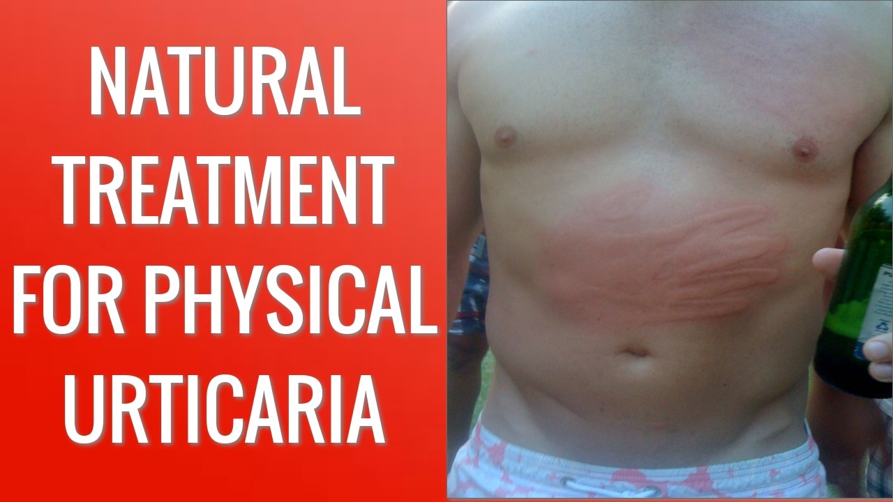 Physical urticaria