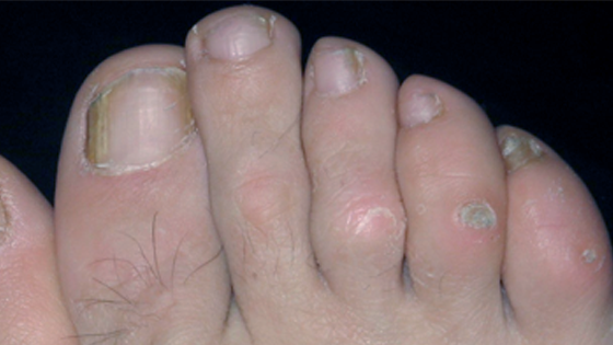 Corns & Calluses - Nashville Podiatrists: The Nashville Foot and Ankle ...