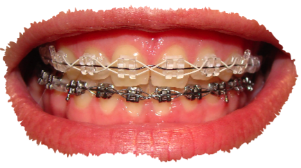 Mein Leben mit Zahnspange: Verblockung? Gummikette? Hä?