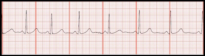 EKG Rhythm Strip Quiz 96: Sinus rhythms