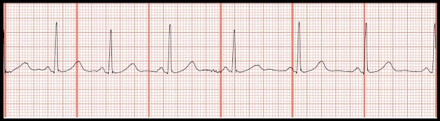 EKG Rhythm Strip Quiz 96: Sinus rhythms