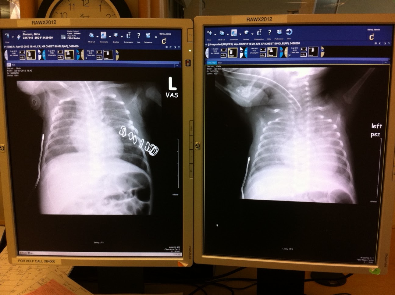 HayesMoMoGirls: Ashlyn had her PDA surgery-she is OK