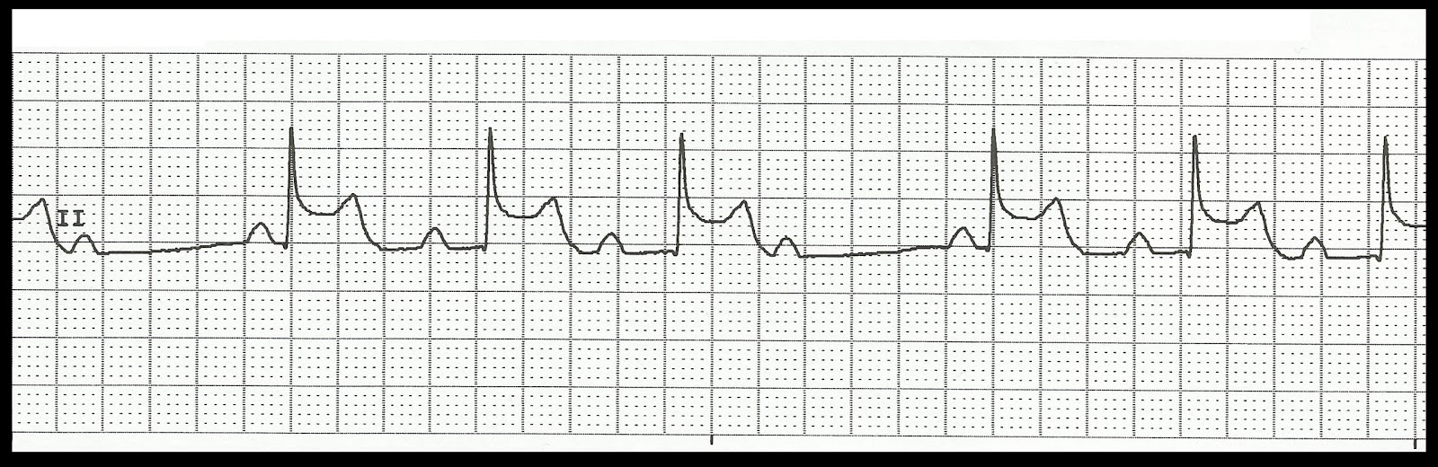 Sinus Rhythm With St Elevation | Images and Photos finder