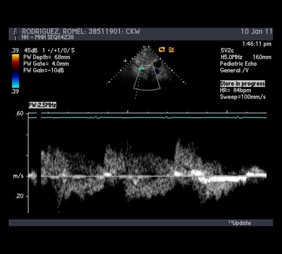Pedi cardiology: Echo: Descending aorta Doppler Pattern, s/p Repair of ...