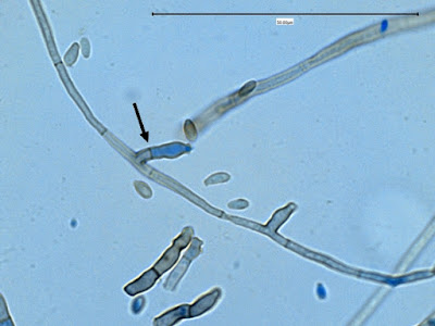 Fun With Microbiology (What's Buggin' You?): Fonsecaea pedrosoi/monophora