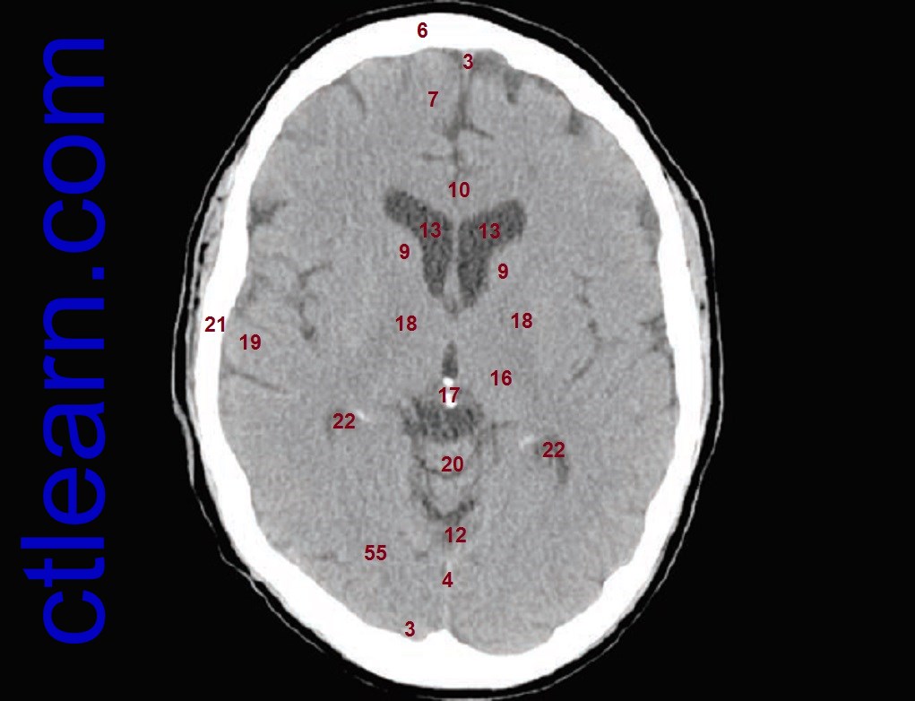 axial ct scan for the brain anatomy axial ct scan for the brain anatomy