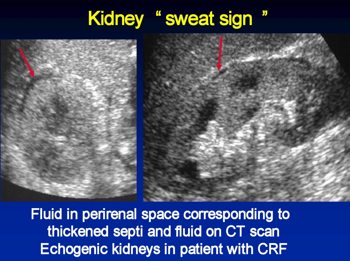 Medical Imaging: Kidney Sweat Sign