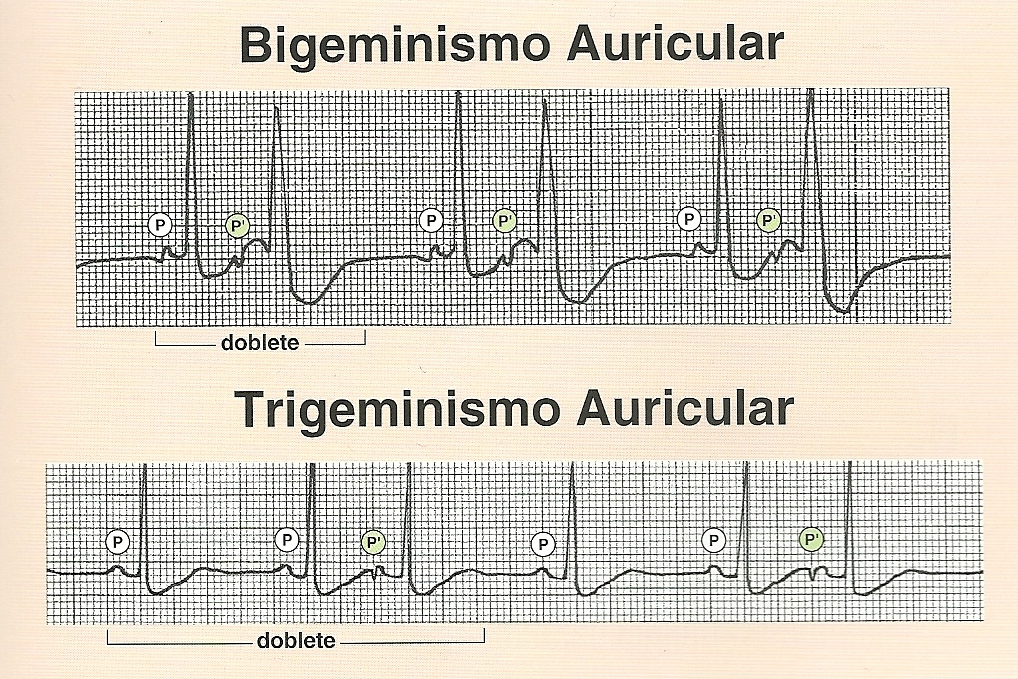 Dr. Rafael Soto - Electrocardiografía - Cardiología clínica: ¿Qué es el ...