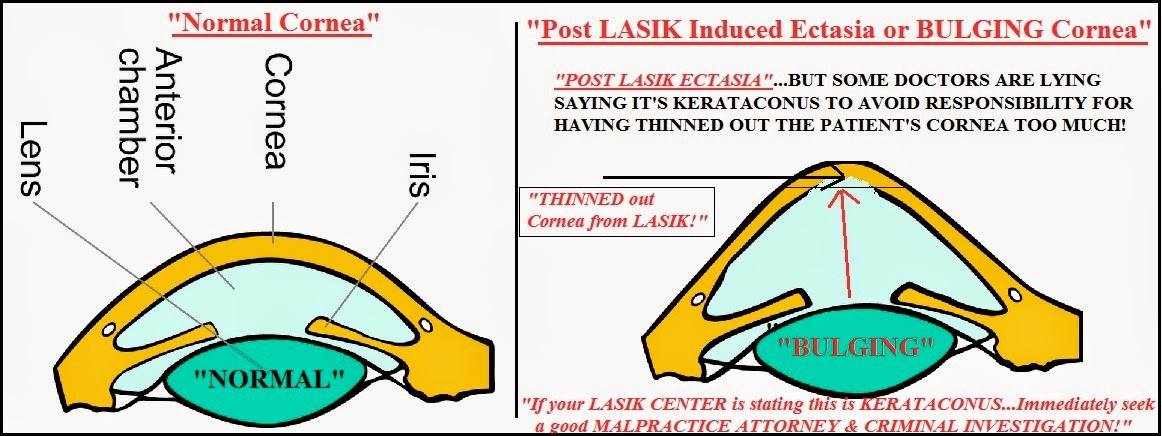 Lasik Eye Surgery: Lasik Double Vision Ghosting