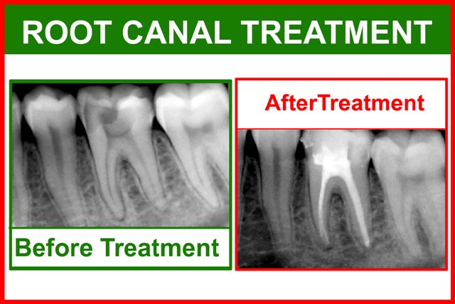 Root Canal Treatment