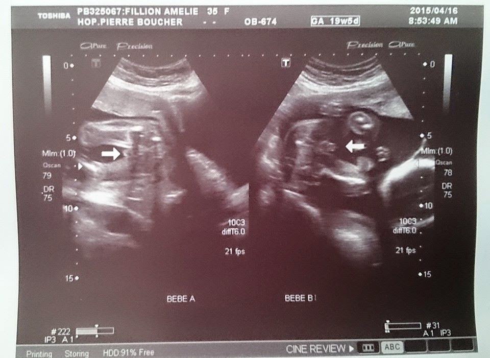 Déroulement de l'échographie morphologique double! ~ Quatre ptits prouts