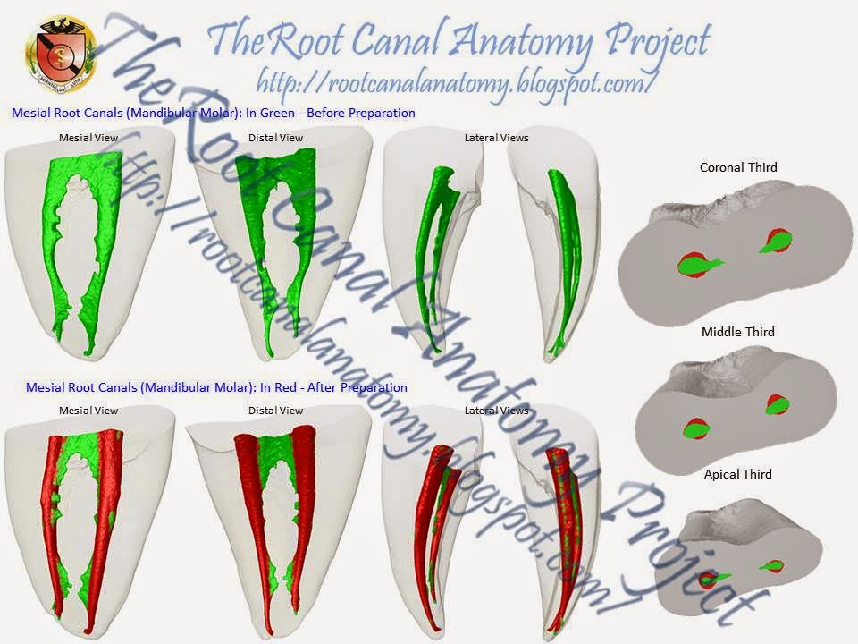 The Root Canal Anatomy Project: Root Canal Anatomy X Rotary Preparation