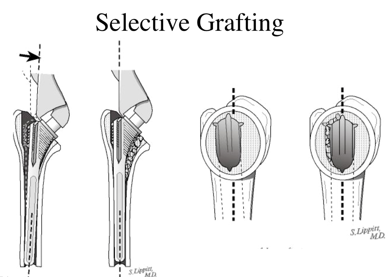 Shoulder and Elbow Surgery: Impaction autografting of the medial calcar ...