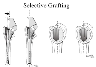 Shoulder and Elbow Surgery: Impaction autografting of the medial calcar ...
