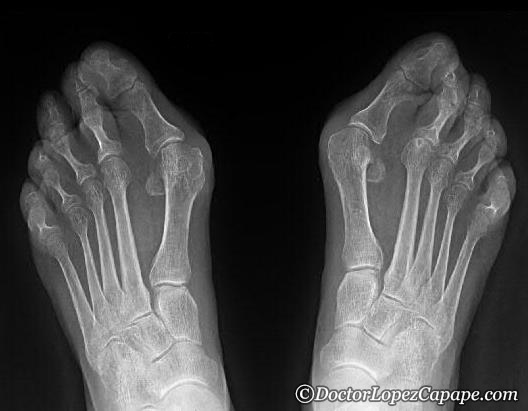 Hallux Valgus | Medicusmeo