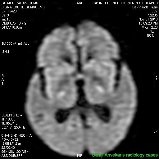 Dr Balaji Anvekar FRCR: Hypoglycemic coma MRI Brain