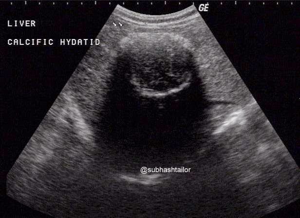SONO DIGEST: ULTRASOUND IN HYDATID DISEASE