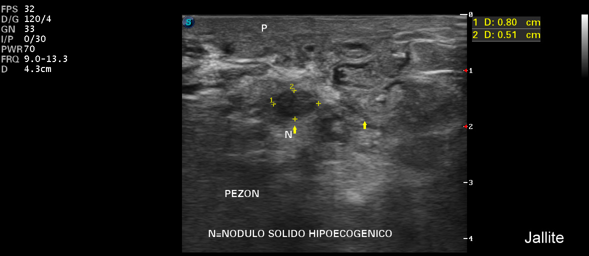 Absceso Mamario en Dos Tiempos