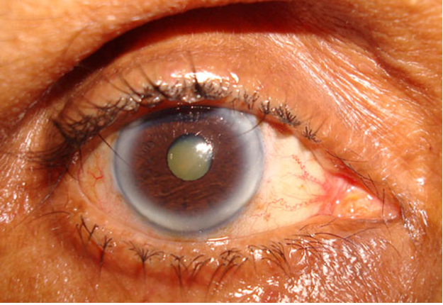 Medical Powerpoint(PPT) Templates: What is Trichiasis Explain With ...