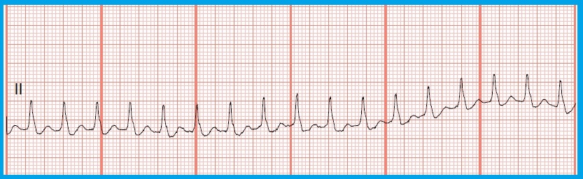 Practice EKG Rhythm Strips 194