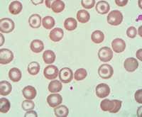 Fichero de Hematología Heber Mayén: octubre 2014