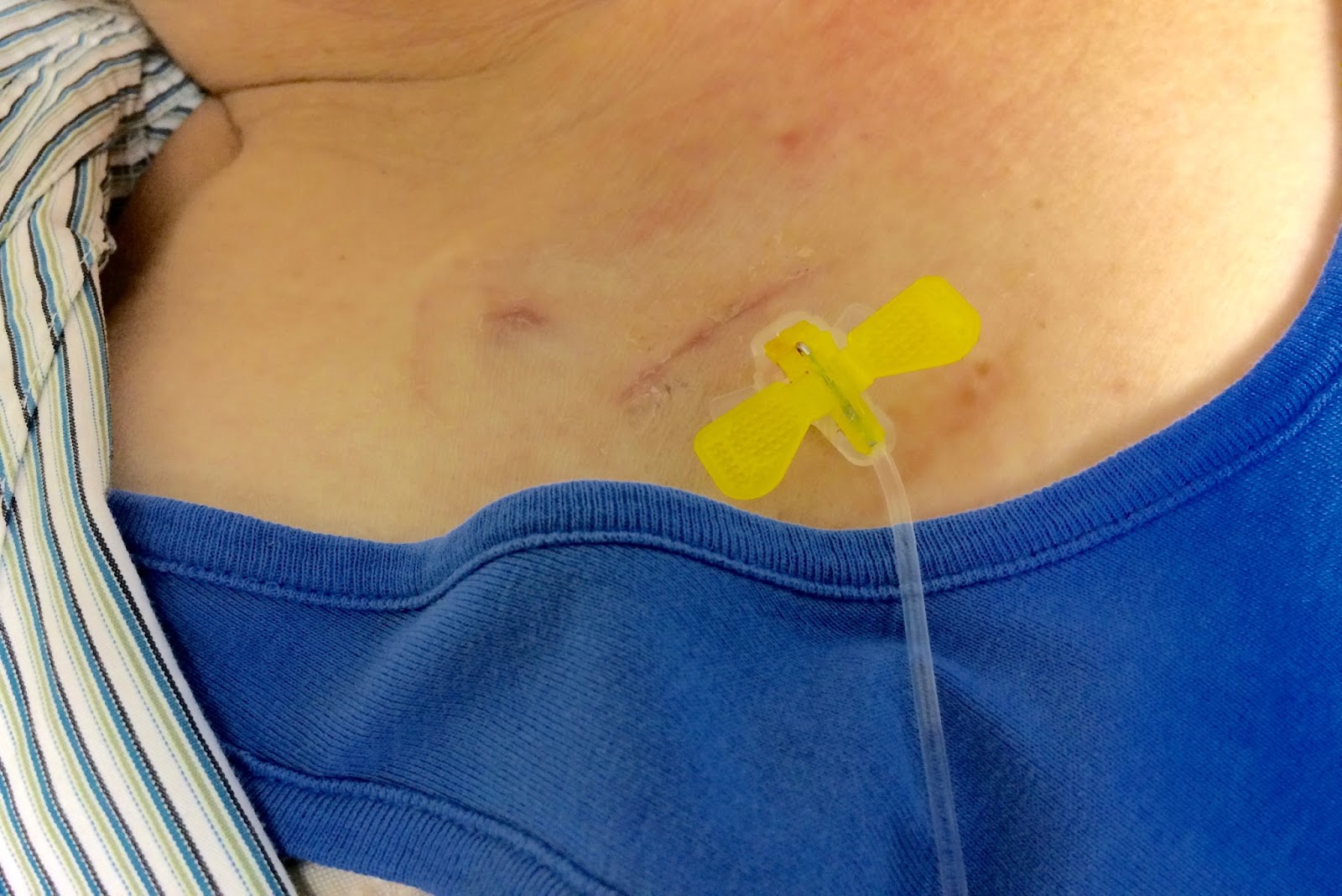 Onward to the Horizon - Life With a Rare Cancer: 2015