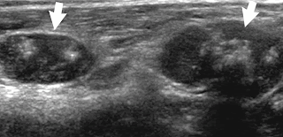 Thyroid: thyroid calcification