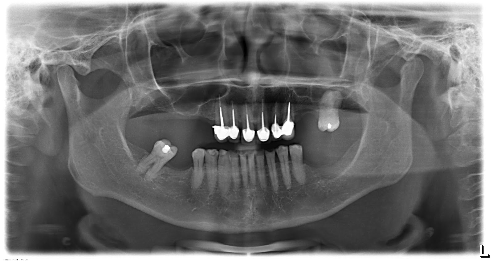 CIRUGIA ORAL Y MAXILOFACIAL EN COLOMBIA: ELEVACION DE SENO MAXILAR ...