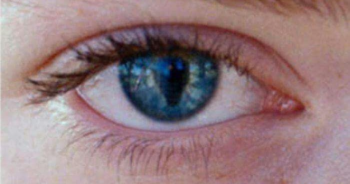 Polycoria Pictures, Symptoms, Causes, Treatment - Health Care Tips and ...