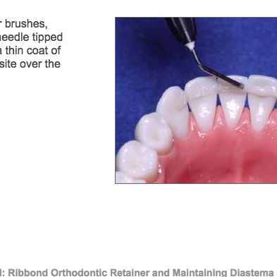 Dental Mart: Ribbond Ribbon Orthodontics 1mm