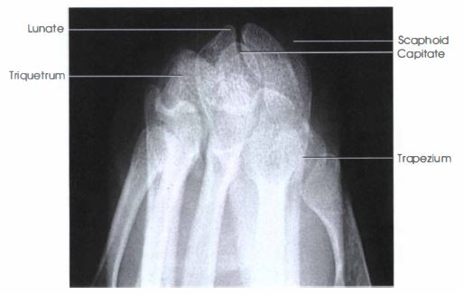 CARPAL BRIDGE - TANGENTIAL PROJECTION: WRIST - RadTechOnDuty